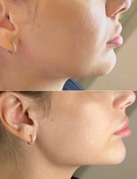 JAWLINE mandibular contour reshaping - Medecine Nutrition et Danse